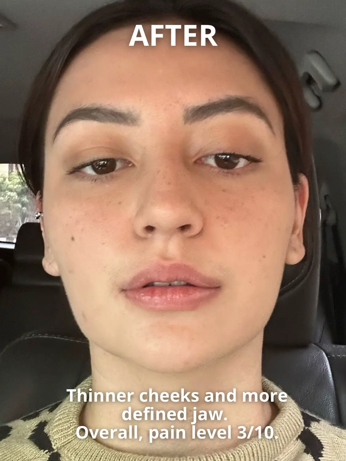 BOTOX RAHANG REVIEW AND RESULT! 🤩 | Galeri diposting oleh mutiarahazle ...