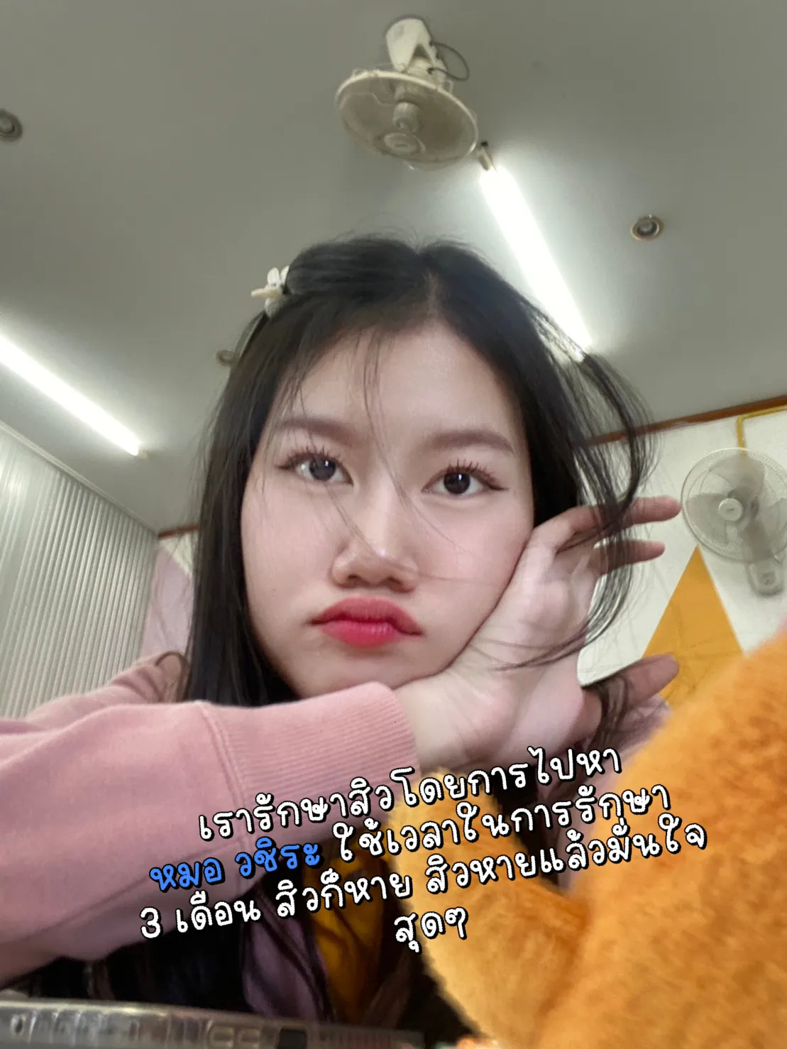 จากสิว สู่..ใส่ | แกลเลอรีที่โพสต์โดย king | Lemon8