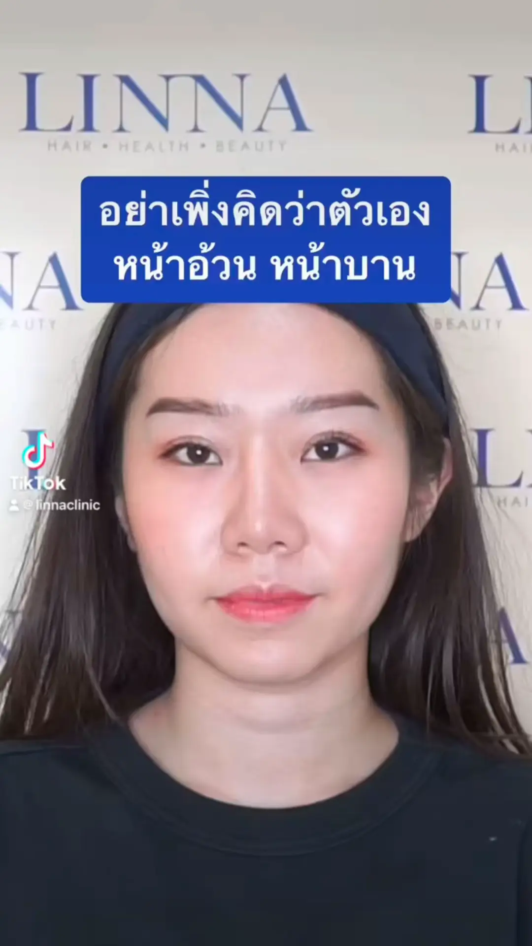 Filler คาง หน้าวี🥰 | Video published by Linnaclinic | Lemon8