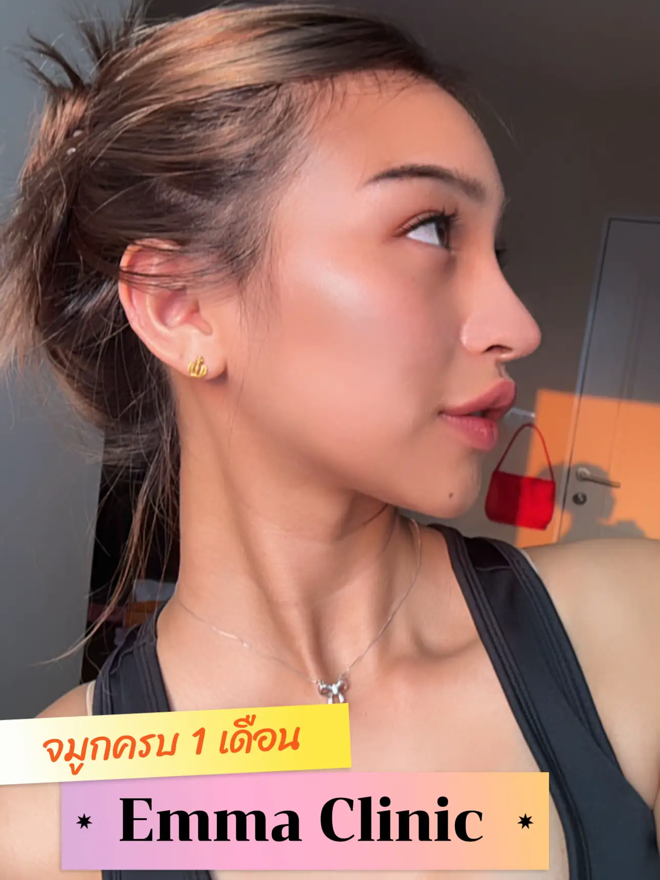 รีวิวจมูกครบ 1 เดือน Emma clinic🌟 | แกลเลอรีที่โพสต์โดย 🧚🏼‍♀️🌟💗 | Lemon8