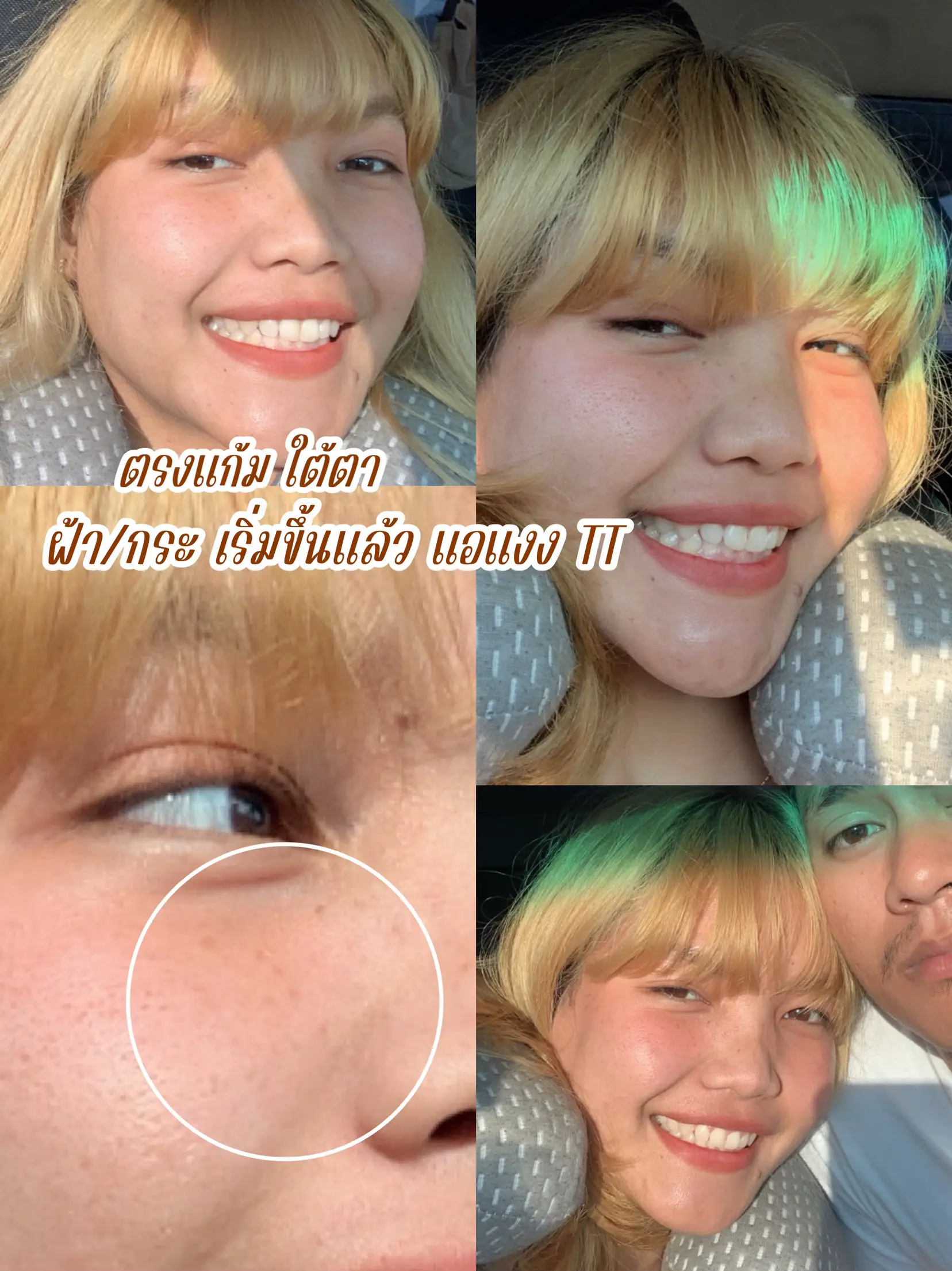 ให้เซรั่ม Mizumi หยุดฝ้า! อย่าให้ฝ้ามาหยุดการเที่ยวของเรา!! | แกลเลอรี ...