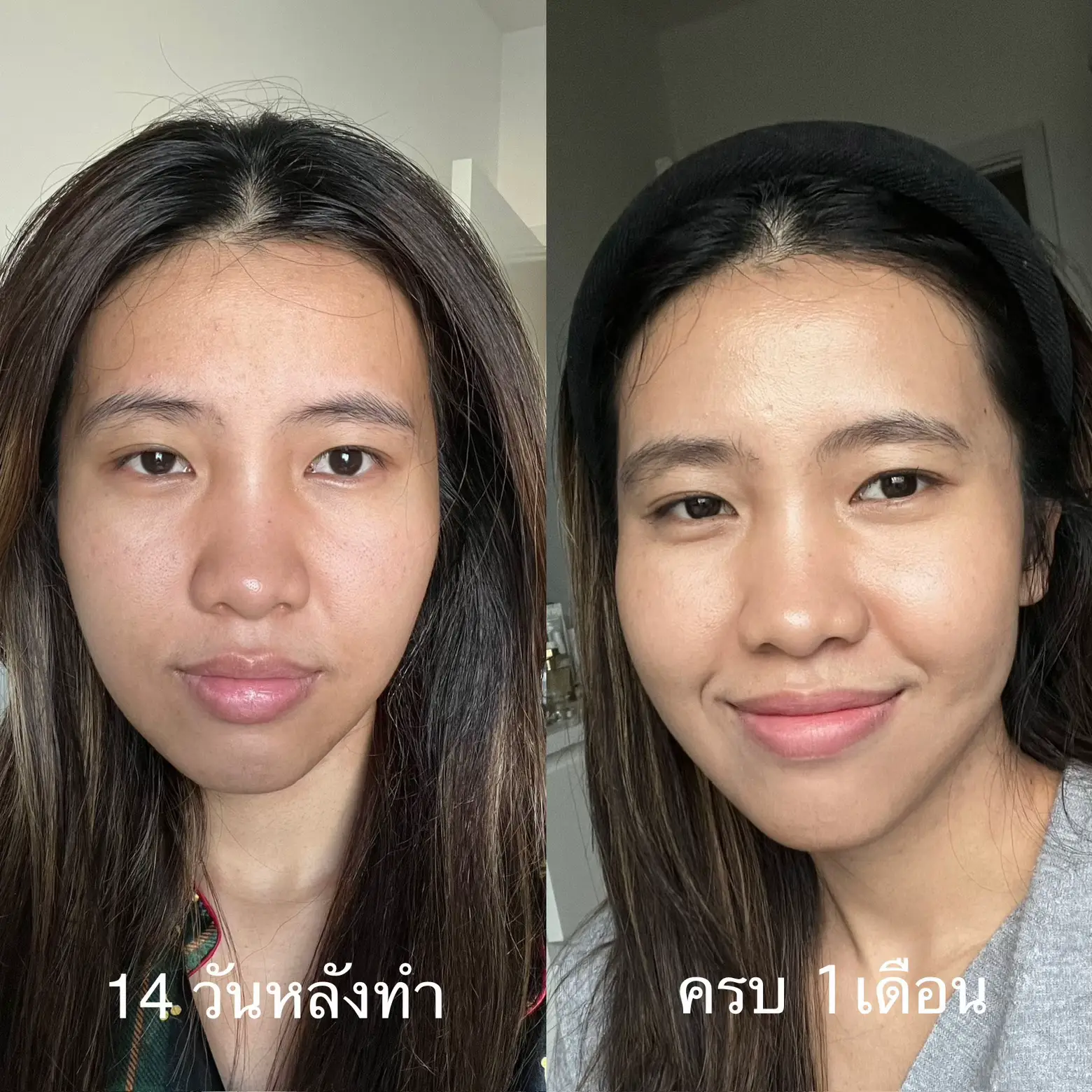 ครั้งแรก!!! Pico Laser | แกลเลอรีที่โพสต์โดย Ingky | Lemon8