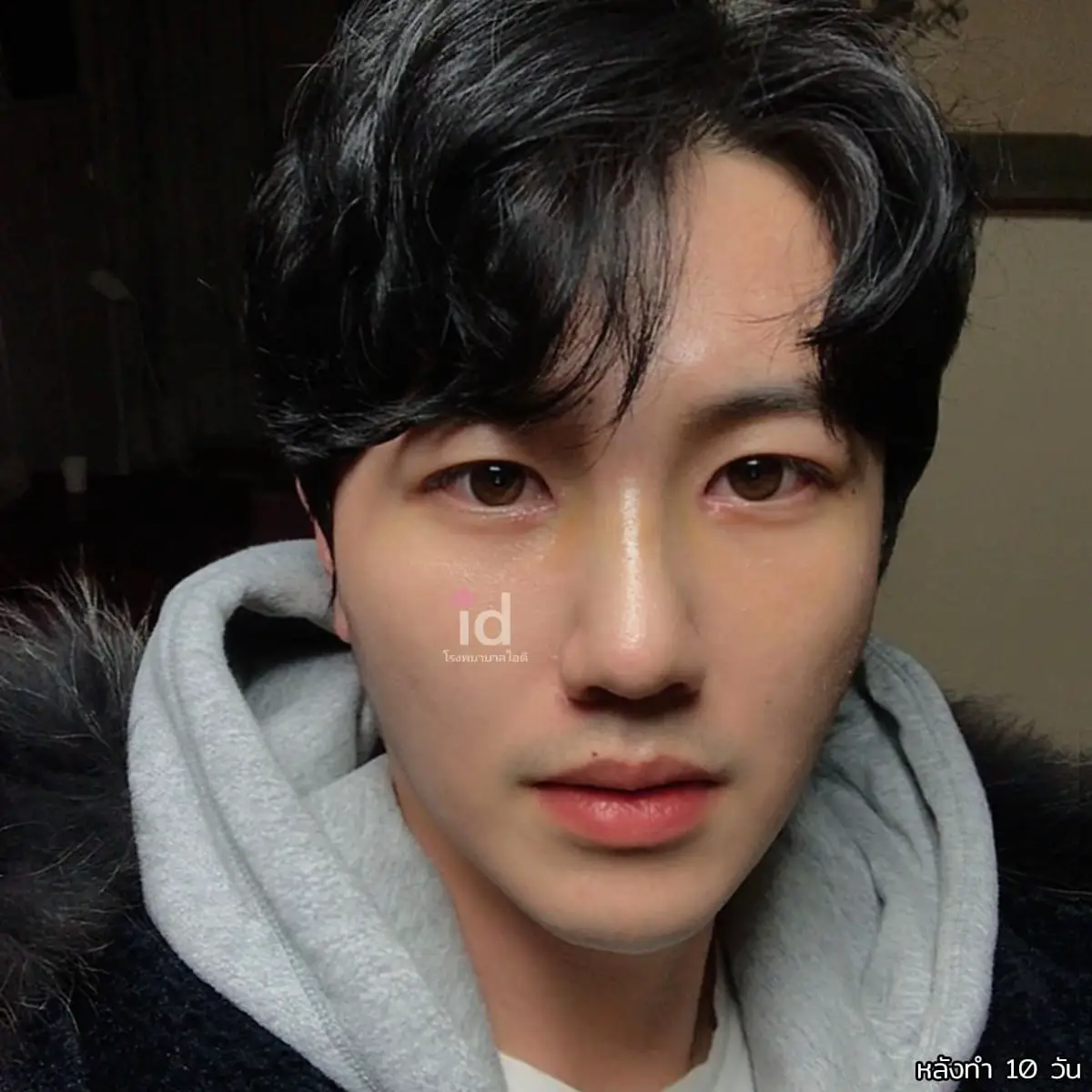 ศัลยกรรมผู้ชาย | แกลเลอรีที่โพสต์โดย Noom BTF | Lemon8