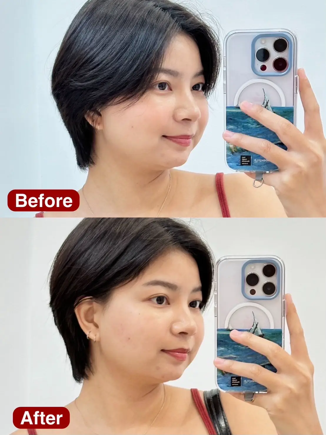 Premium Hifu สองแบ้งค์เทามีทอน เห็นผลจริง😱😱 | แกลเลอรีที่โพสต์โดย ตอเต่าป้ายยา💋👊🏻 | Lemon8