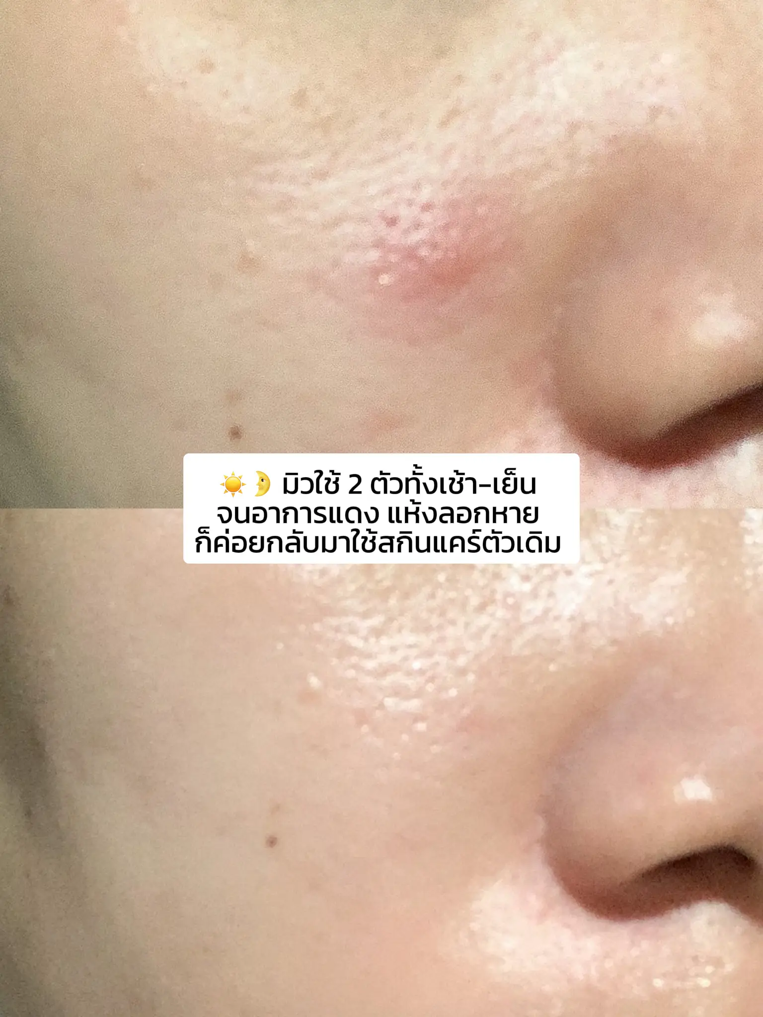 สกินแคร์ที่ใช้ช่วงผิวอ่อนแอ | แกลเลอรีที่โพสต์โดย MOREMEWZ | Lemon8