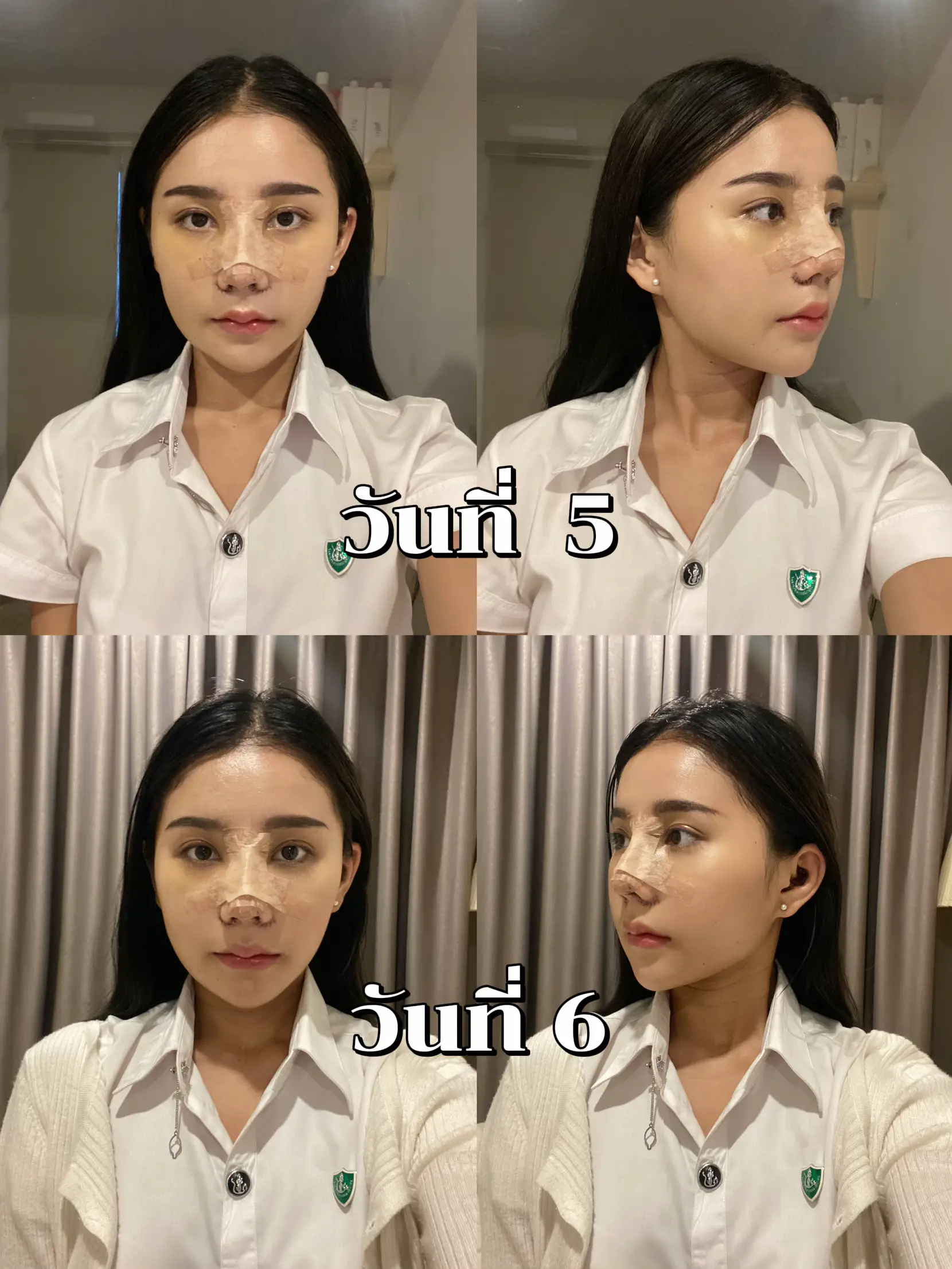 ศัลยกรรมครั้งแรกในชีวิต ปังหรือพัง ‼️ | แกลเลอรีที่โพสต์โดย Nu Dee🐰 | Lemon8