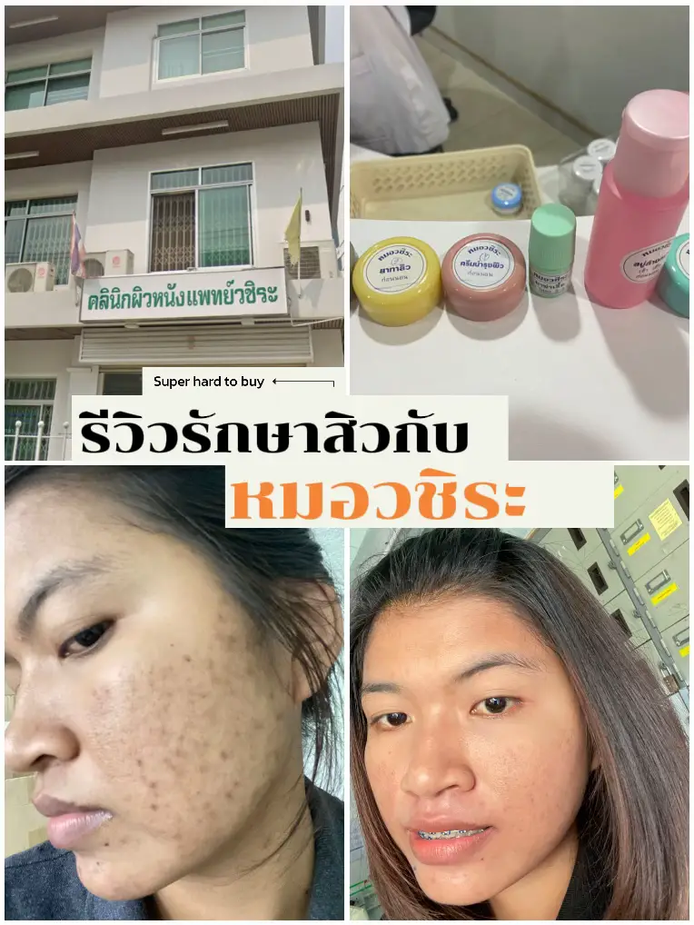 รีวิว รักษาสิวหมอวชิระ | แกลเลอรีที่โพสต์โดย Maneerat Tongta | Lemon8