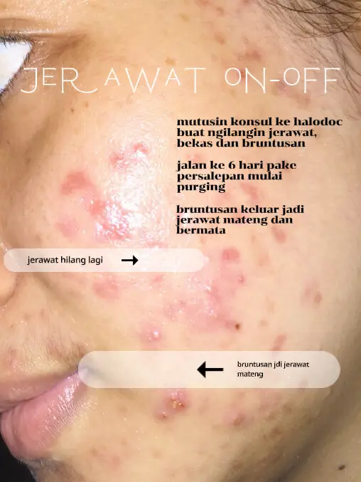 Tantangan tersulit adalah hempas jerawat!! | Galeri diposting oleh Imass | Lemon8