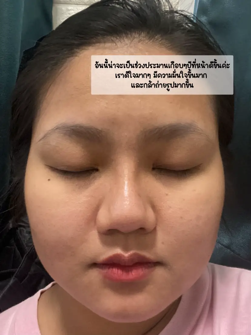 แชร์ประสบการณ์เป็นสิวมานาน 6 ปี ทำยังไงถึงหาย แกลเลอรีที่โพสต์โดย