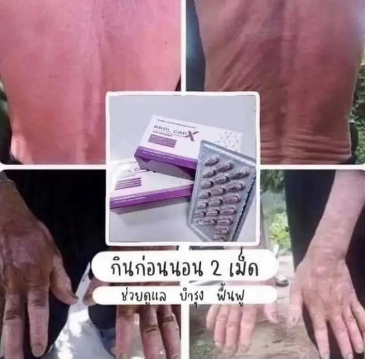 Prpl CapX Treat Psoriasis | Gallery posted by Praew B:Health | Lemon8