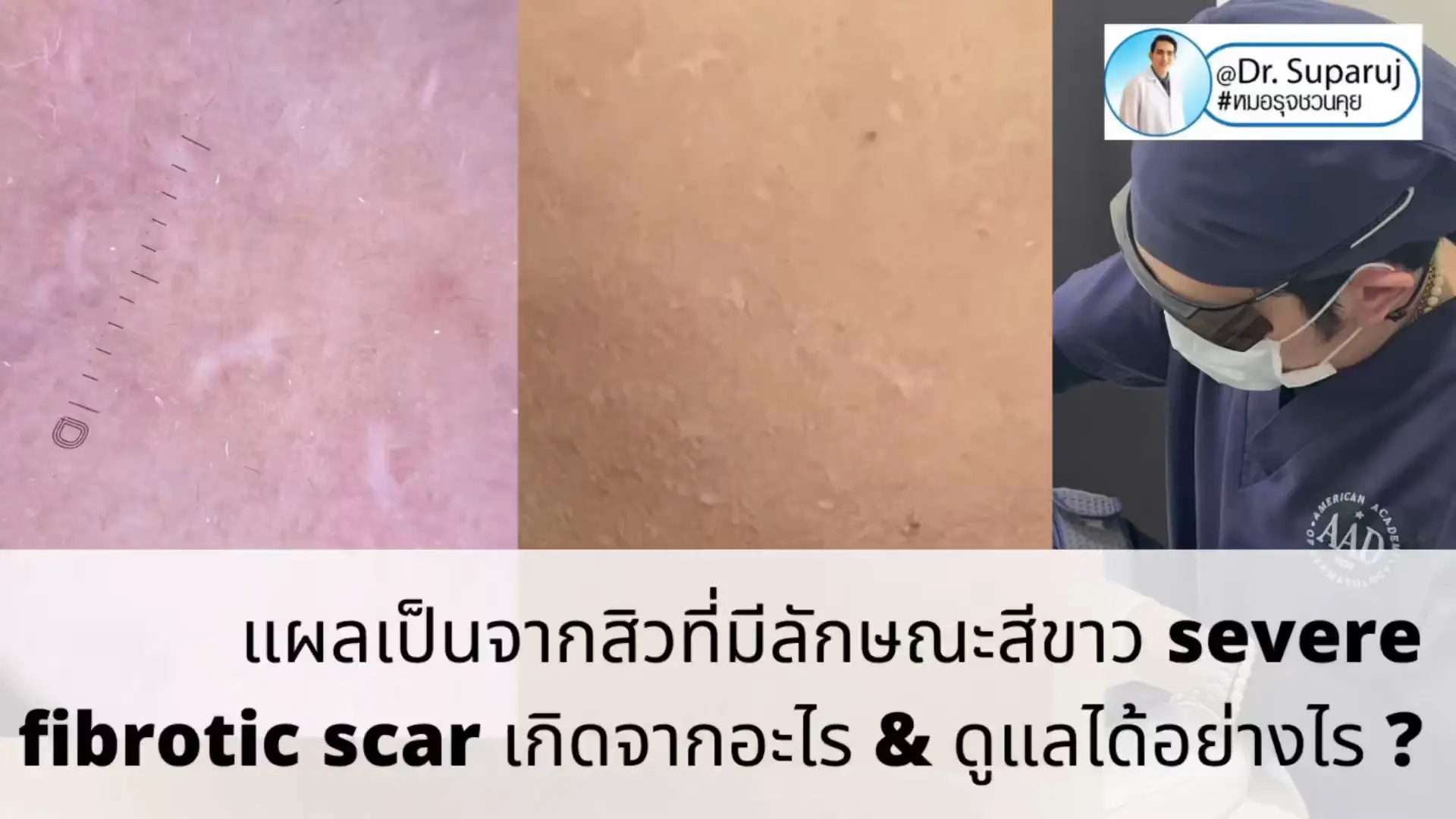 แผลเป็นจากสิวที่มีลักษณะสีขาว severe fibrotic acne scar | วิดีโอที่ ...