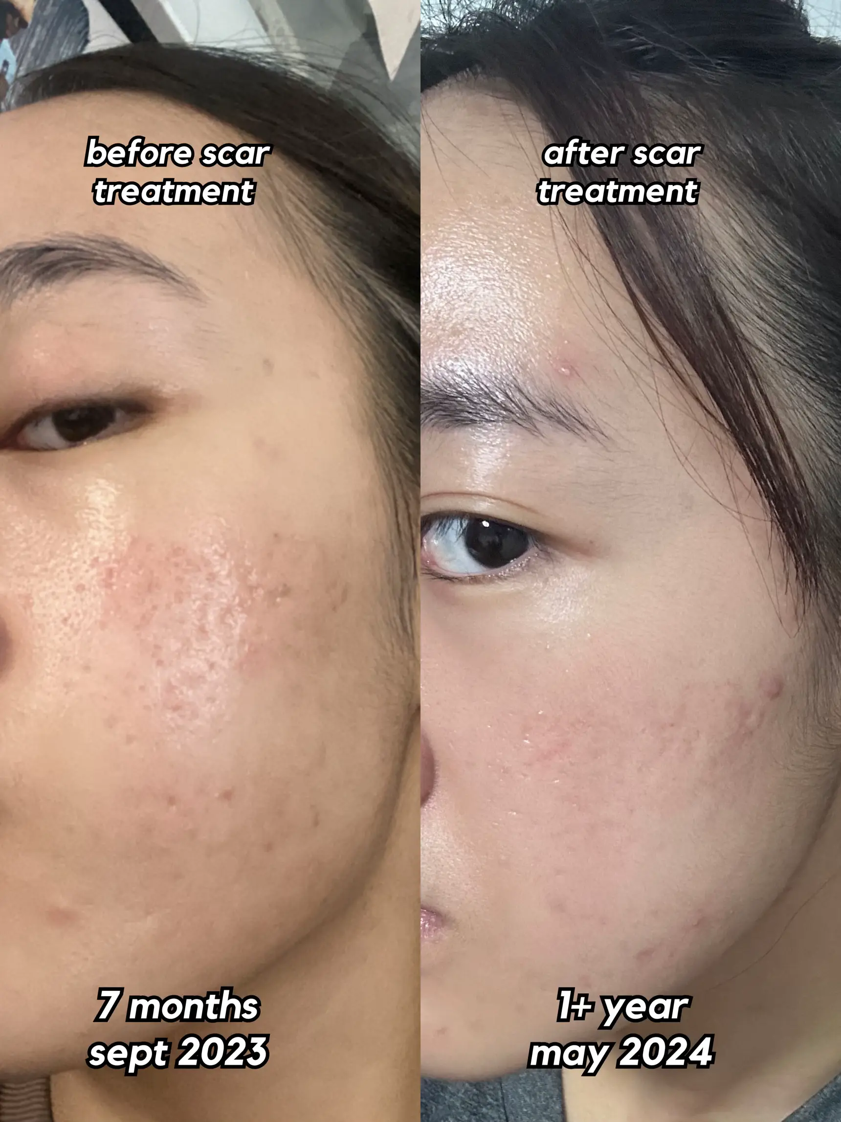 MY COMPLETE ACNE HEALING JOURNEY 🥹🥹🥹 | Gallery posted by JADE 👁️ | Lemon8