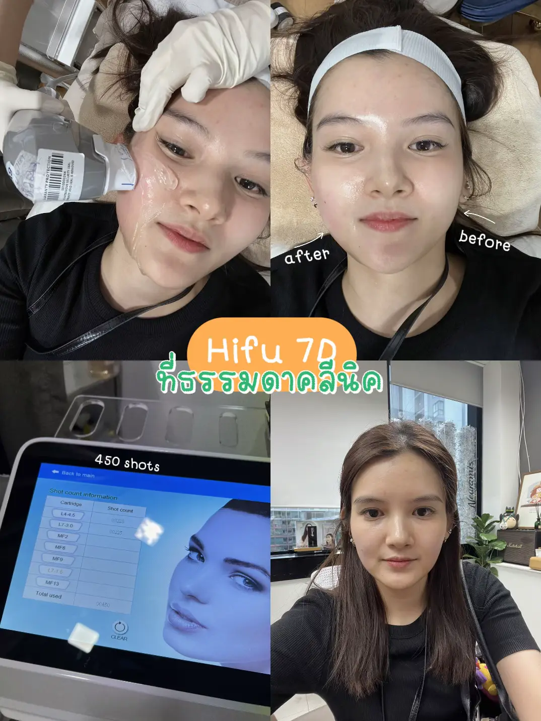 รีวิวทำ Hifu 7D @tamada clinic bts ปุณณวิถี ☁️ | แกลเลอรีที่โพสต์โดย Earnyakul | Lemon8