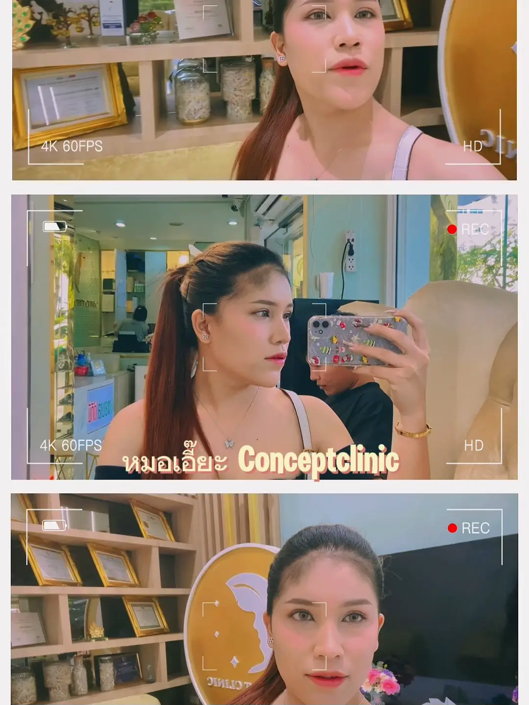 หน้าล่าสุด ฝสกไว้ที่คุณหมอเอี๊ | วิดีโอที่เผยแพร่โดย Ayumii Chalotor | Lemon8