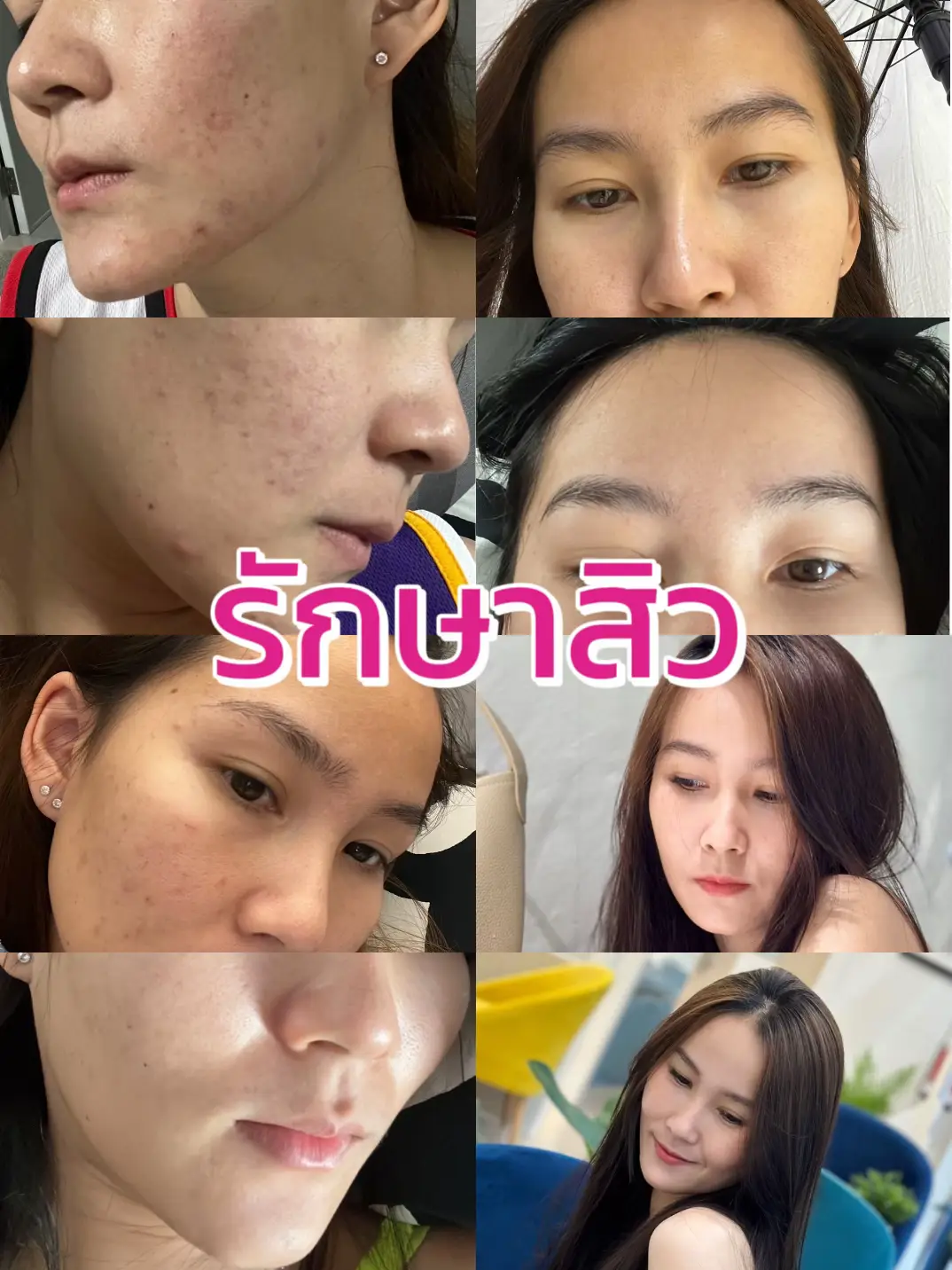 รักษาสิวเอง + หาหมอ pan clinic ดีมาก | แกลเลอรีที่โพสต์โดย buatong.m | Lemon8