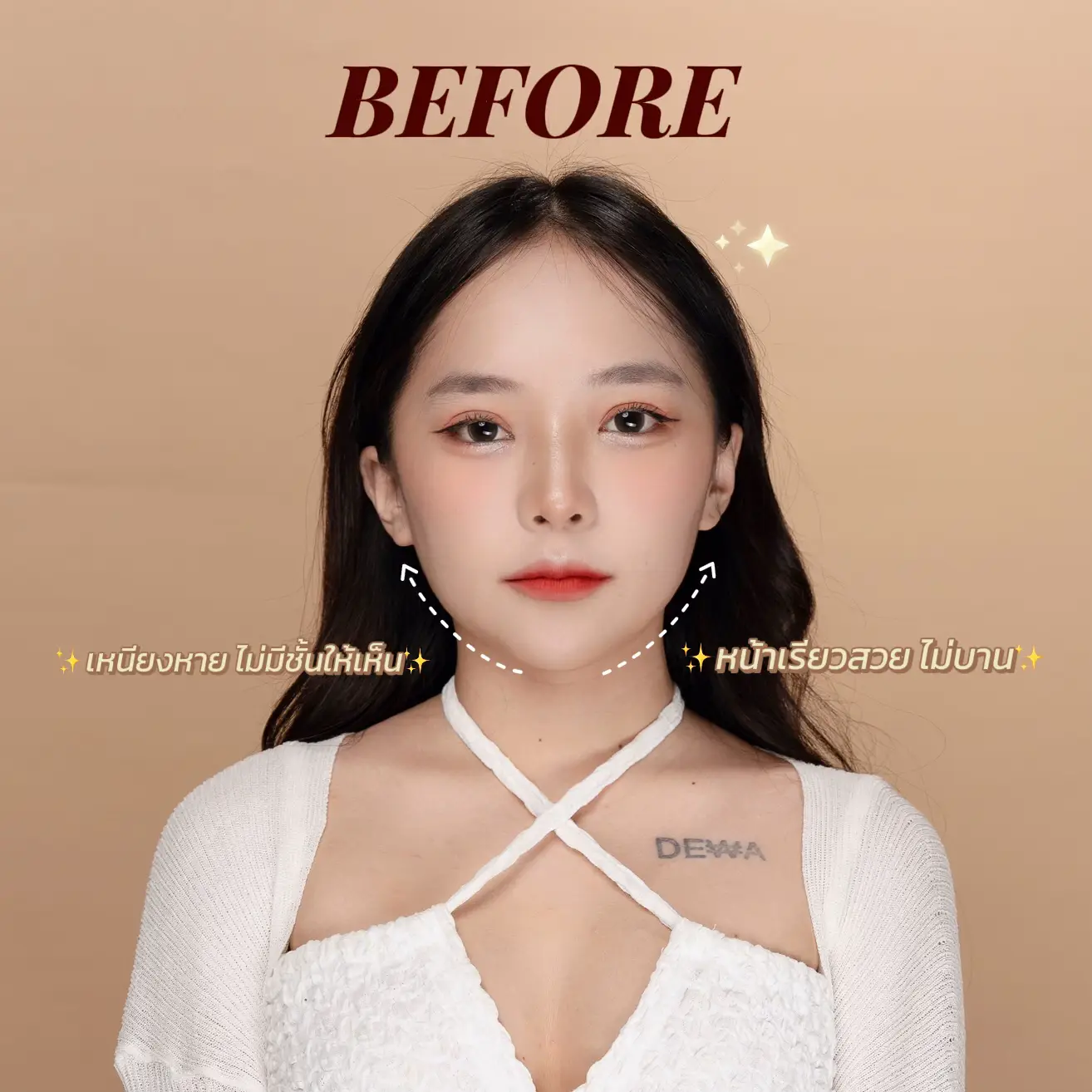 Botox กราม + Meso fat แก้ปัญหาหน้ากลมหน้าบาน!! | แกลเลอรีที่โพสต์โดย Dr.Karn Beauty | Lemon8