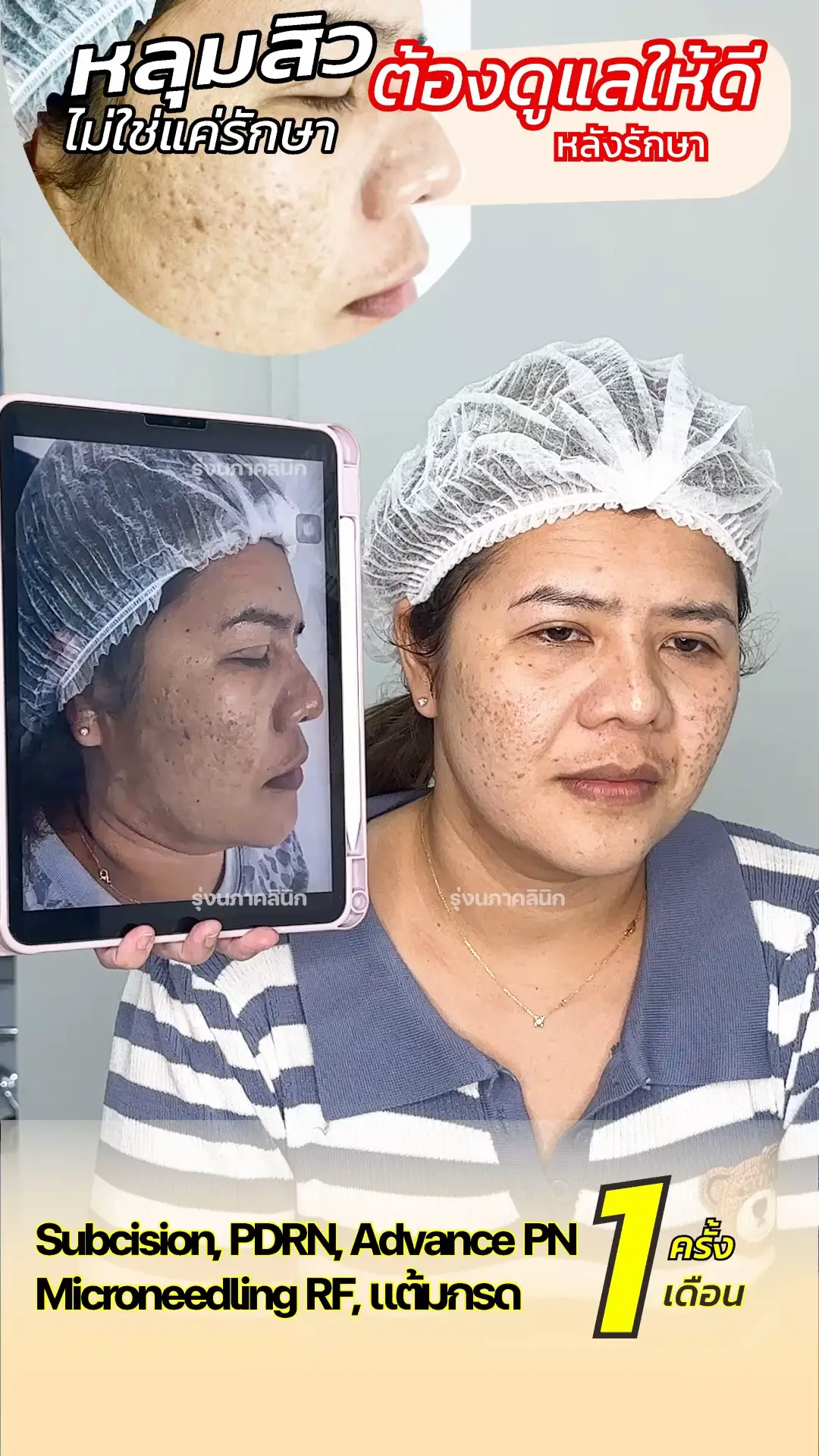 รักษาหลุมสิวรอบเดียว เป็นไงมาดูกัน | วิดีโอที่เผยแพร่โดย Dr.Ploy รุ่งนภา | Lemon8