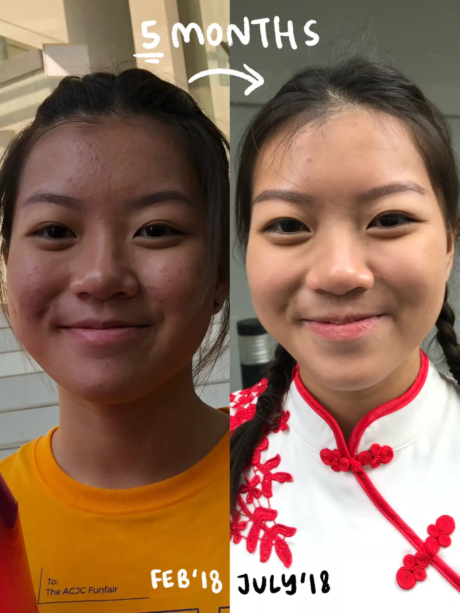 how accutane transformed and cleared my skin 🤍 | Gallery posted by ...