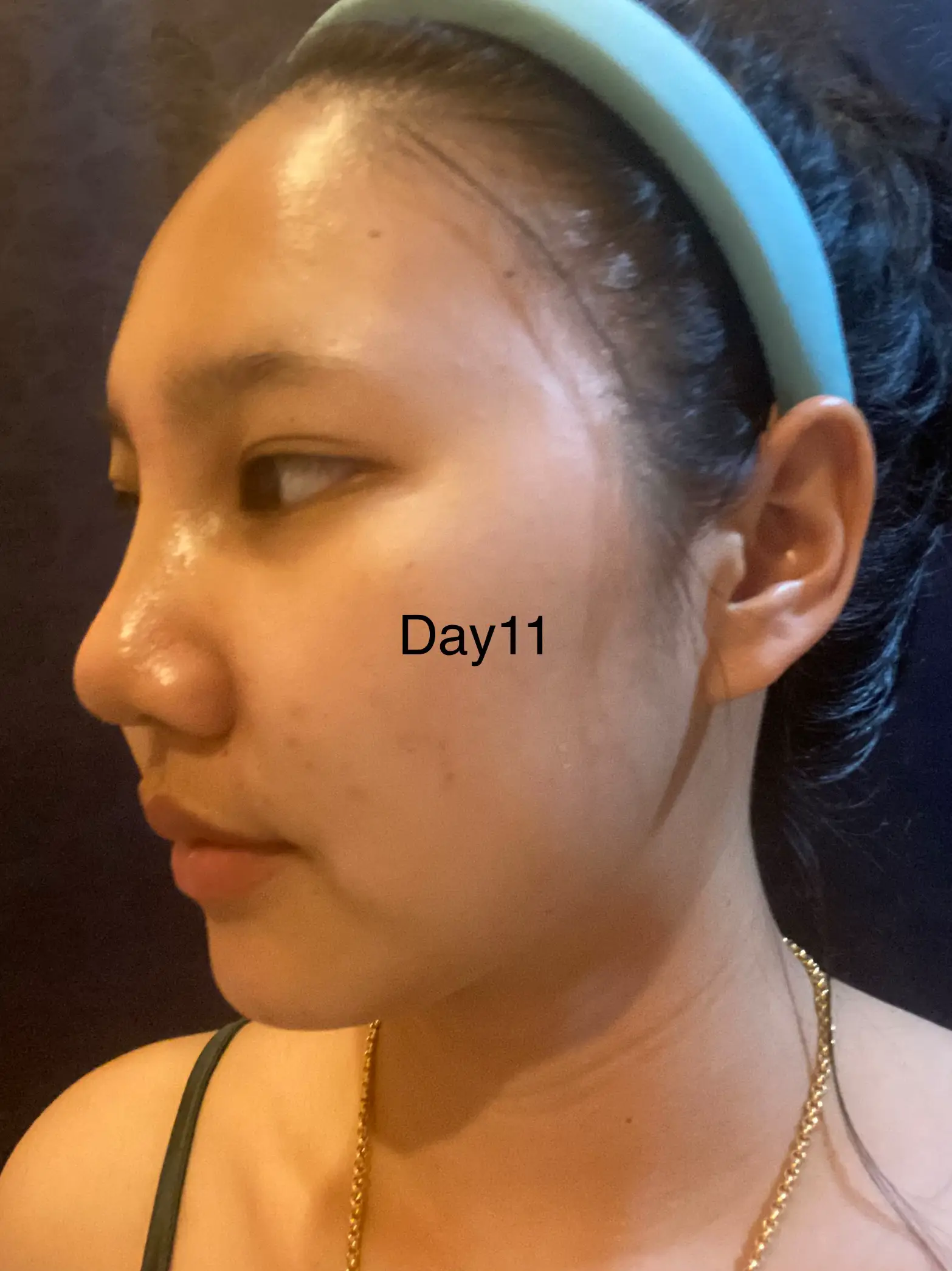 ประสบการณ์ทำจมูกครั้งแรก👃🏻 | แกลเลอรีที่โพสต์โดย Yns. | Lemon8