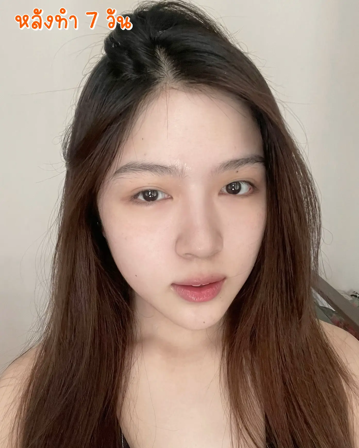 ทำ Pico Laser ครบ 14 วันแล้ววว☺️☺️ | แกลเลอรีที่โพสต์โดย วินเซนต์พารีวิว | Lemon8