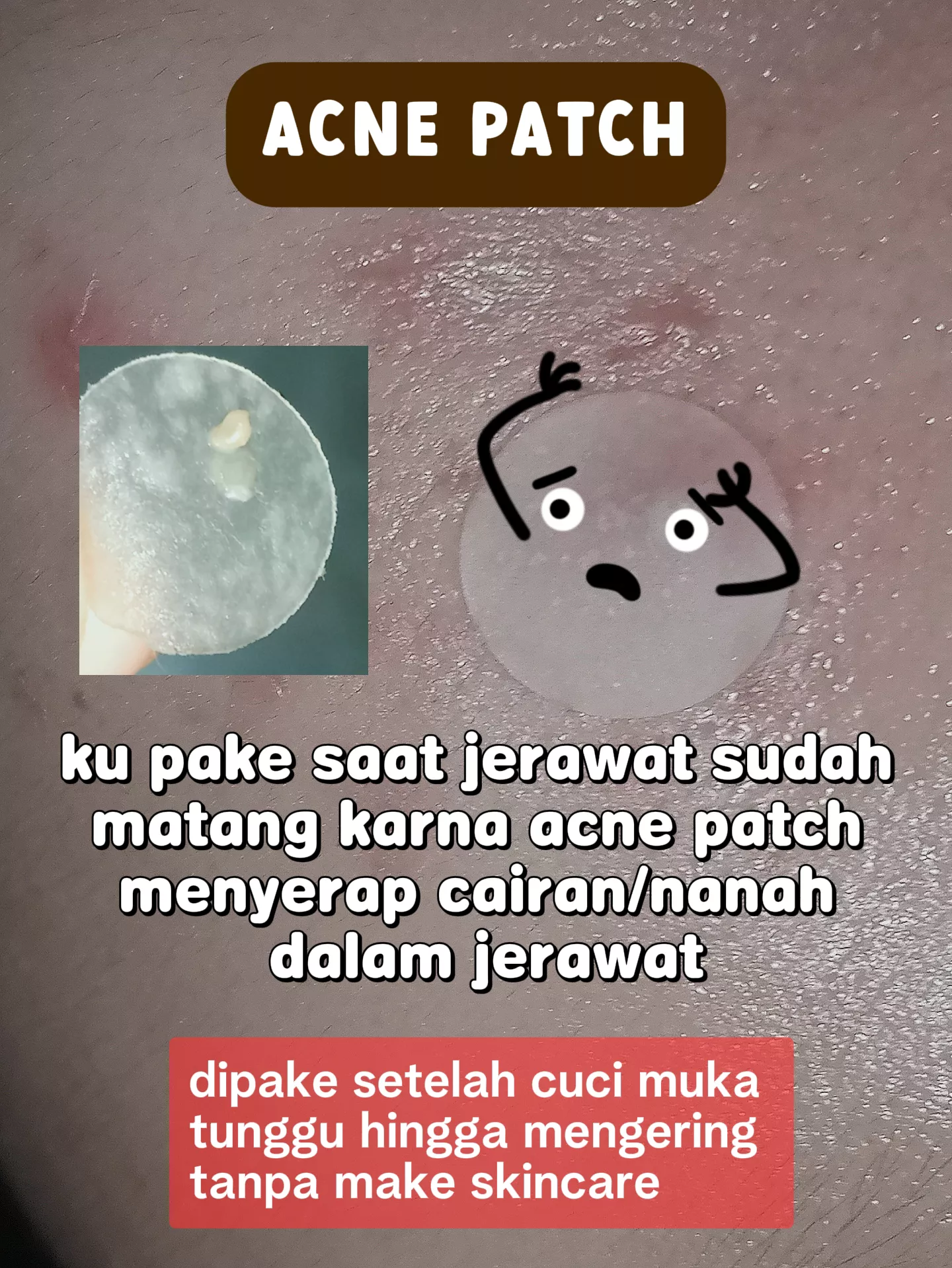 CARA AKU NGATASIN JERAWAT PURGING | Galeri diposting oleh . | Lemon8