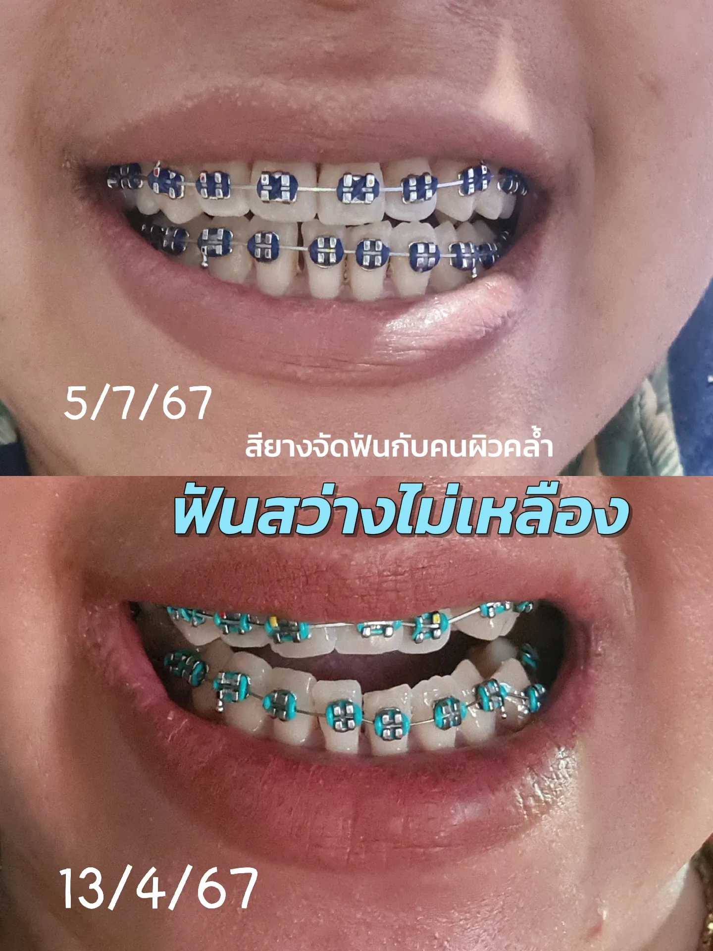 สียางจัดฟันกับคนผิวคล้ำ | แกลเลอรีที่โพสต์โดย boorin😋 | Lemon8