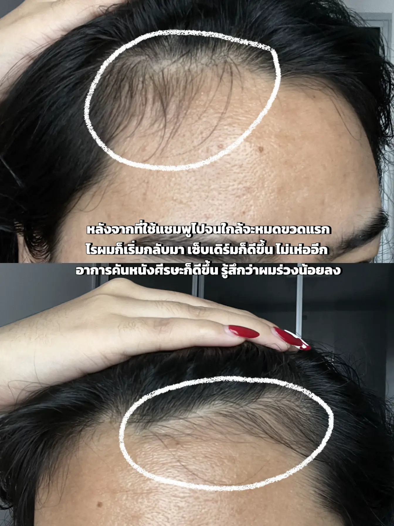 แชมพูตัวเด็ด แก้รังแค หนังหัวลอก เซ็บเดิร์ม คันหนังศีรษะ | แกลเลอรีที่โพสต์โดย I’am cy | Lemon8