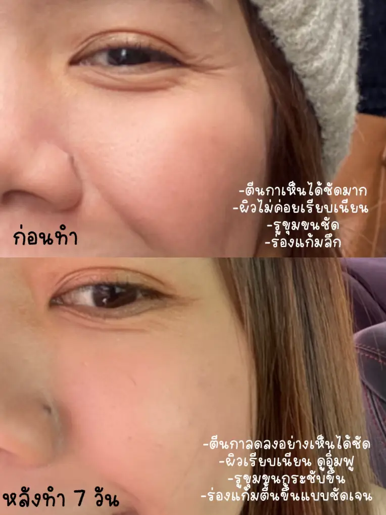 รีวิว ฉีดExosome+Botox หางตาที่เกาหลี 🇰🇷 | แกลเลอรีที่โพสต์โดย 🌧️lipidnamfon 🌈 | Lemon8
