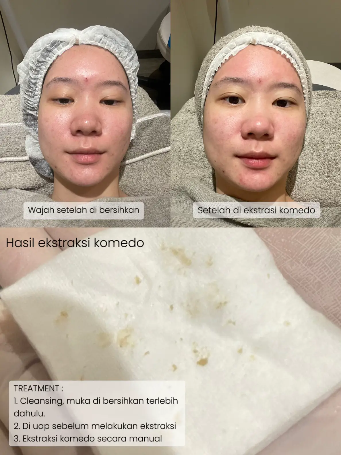 FACIAL TREATMENT 100RB-AN? | Galeri diposting oleh Santamabel | Lemon8
