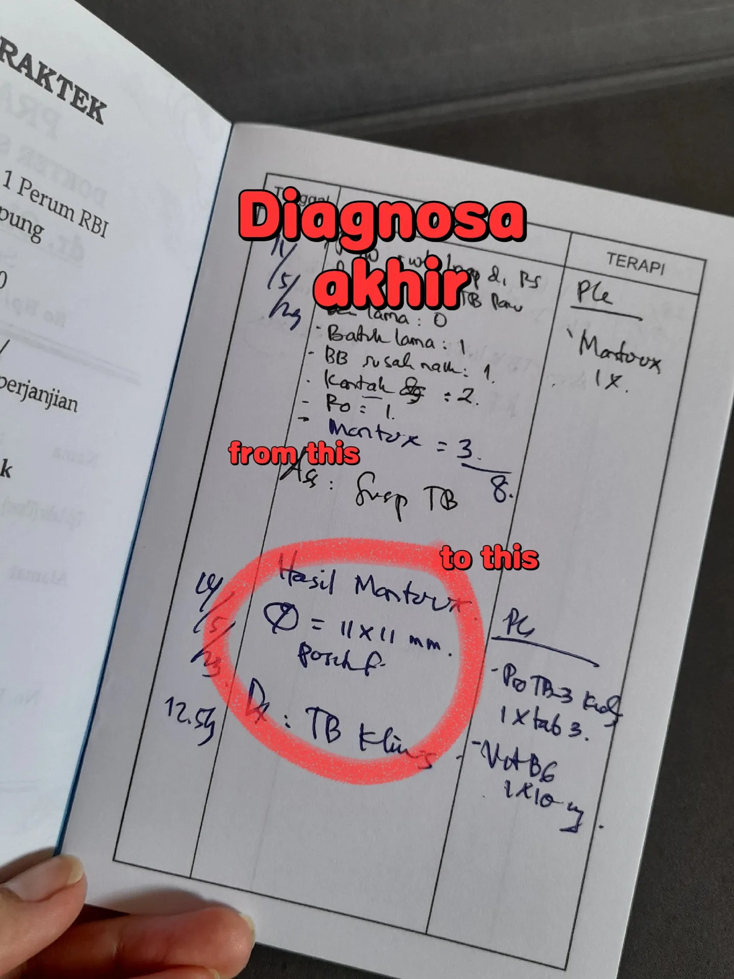 ‼️KEDUA ANAK - KU, POSITIF TB ANAK‼️ | Galeri diposting oleh momirtern | Lemon8