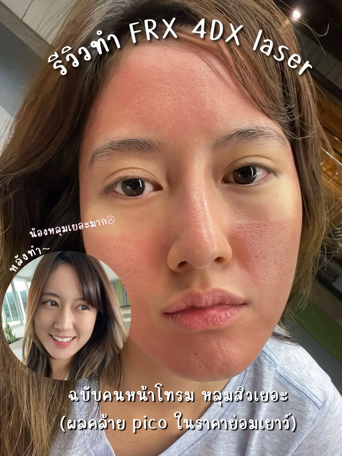 รีวิวทำ FRX 4DX laser ลดรอยสิวหน้าหมอง | แกลเลอรีที่โพสต์โดย Bicky ...