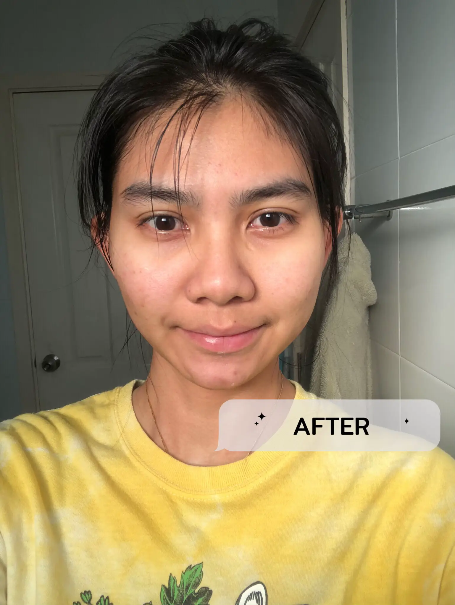 Who has acne marks like us? Come this way.🙋🏼‍♀️ | Gallery posted by fern | Lemon8