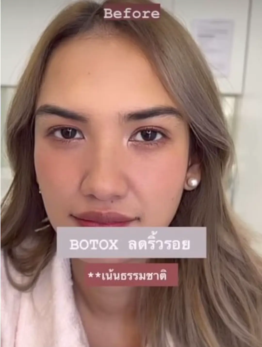Botox ลดเลือนริ้วรอย 👨🏻‍⚕️ | วิดีโอที่เผยแพร่โดย Ssense Clinic | Lemon8