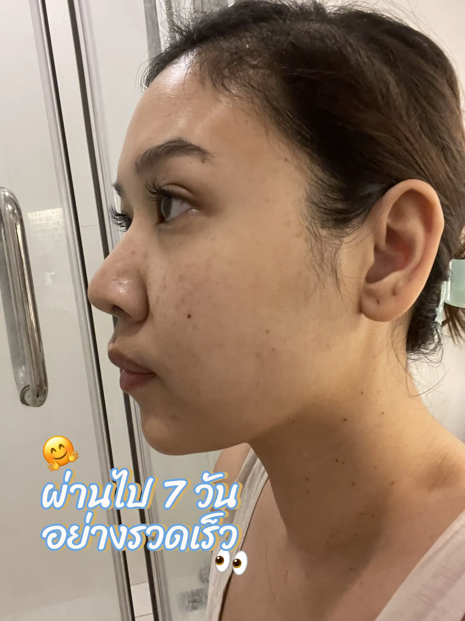 รีวิว Laser Co2 กระเนื้อ | แกลเลอรีที่โพสต์โดย Pyms Py | Lemon8