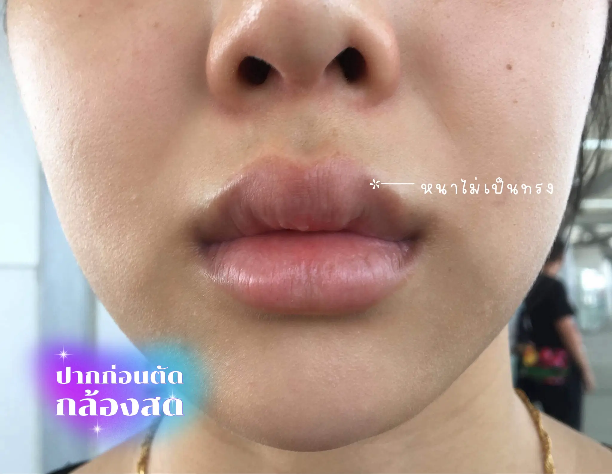 รีวิวตัดปาก กับหมออันดับ1 ของไทย👄 | แกลเลอรีที่โพสต์โดย Orm aam | Lemon8