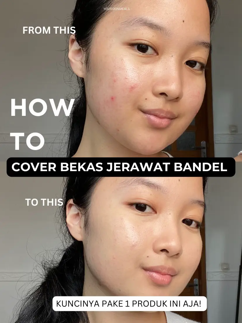 Pake 1 produk ini bekas jerawat bandel ketutup?!😱 | Video dipublikasikan oleh yourskinmeals | Lemon8