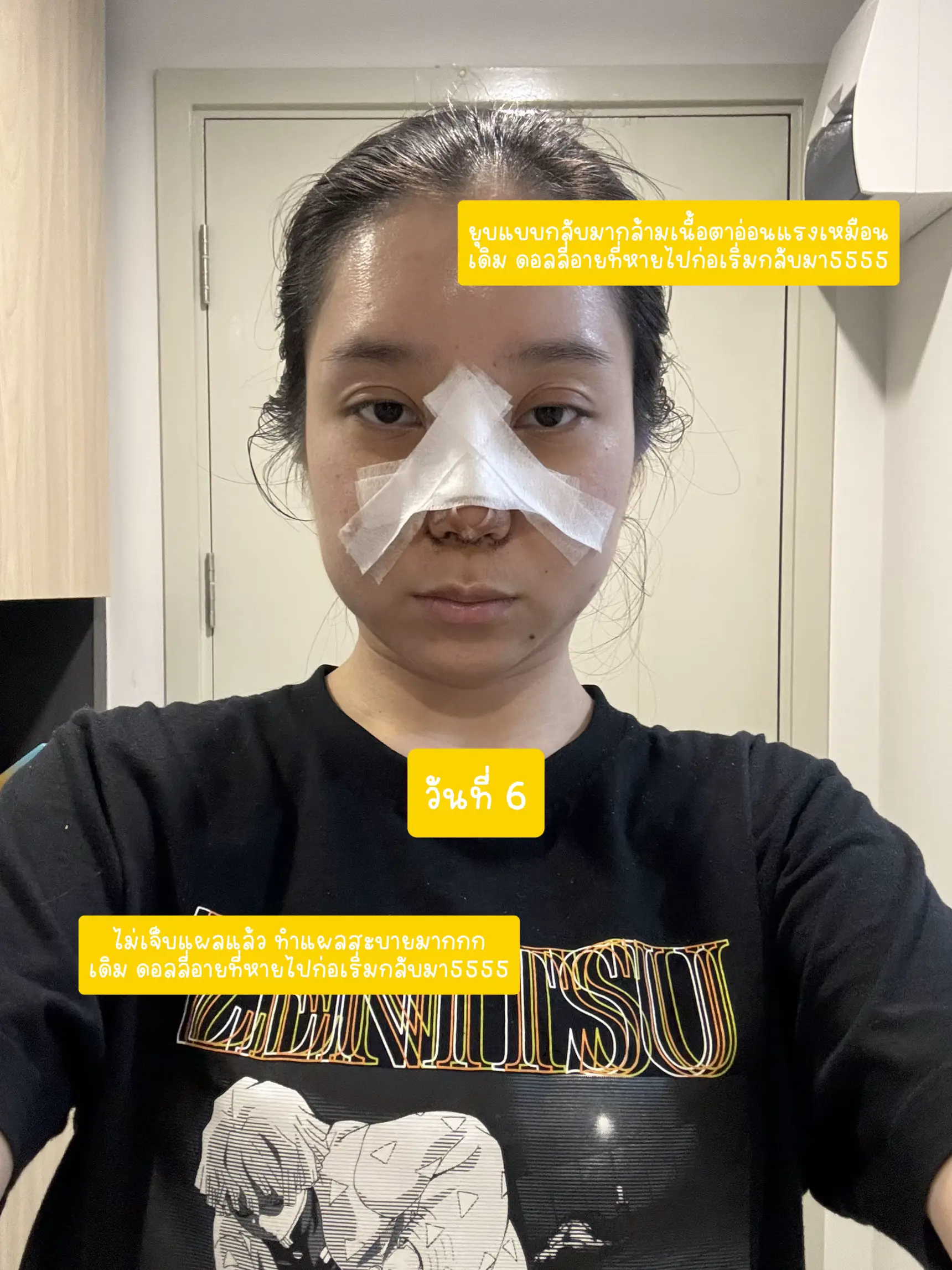 พรีชีพ ครั้งแรก เสริมจมูก full open+กระดูกหลังหู no spon | แกลเลอรีที่ ...