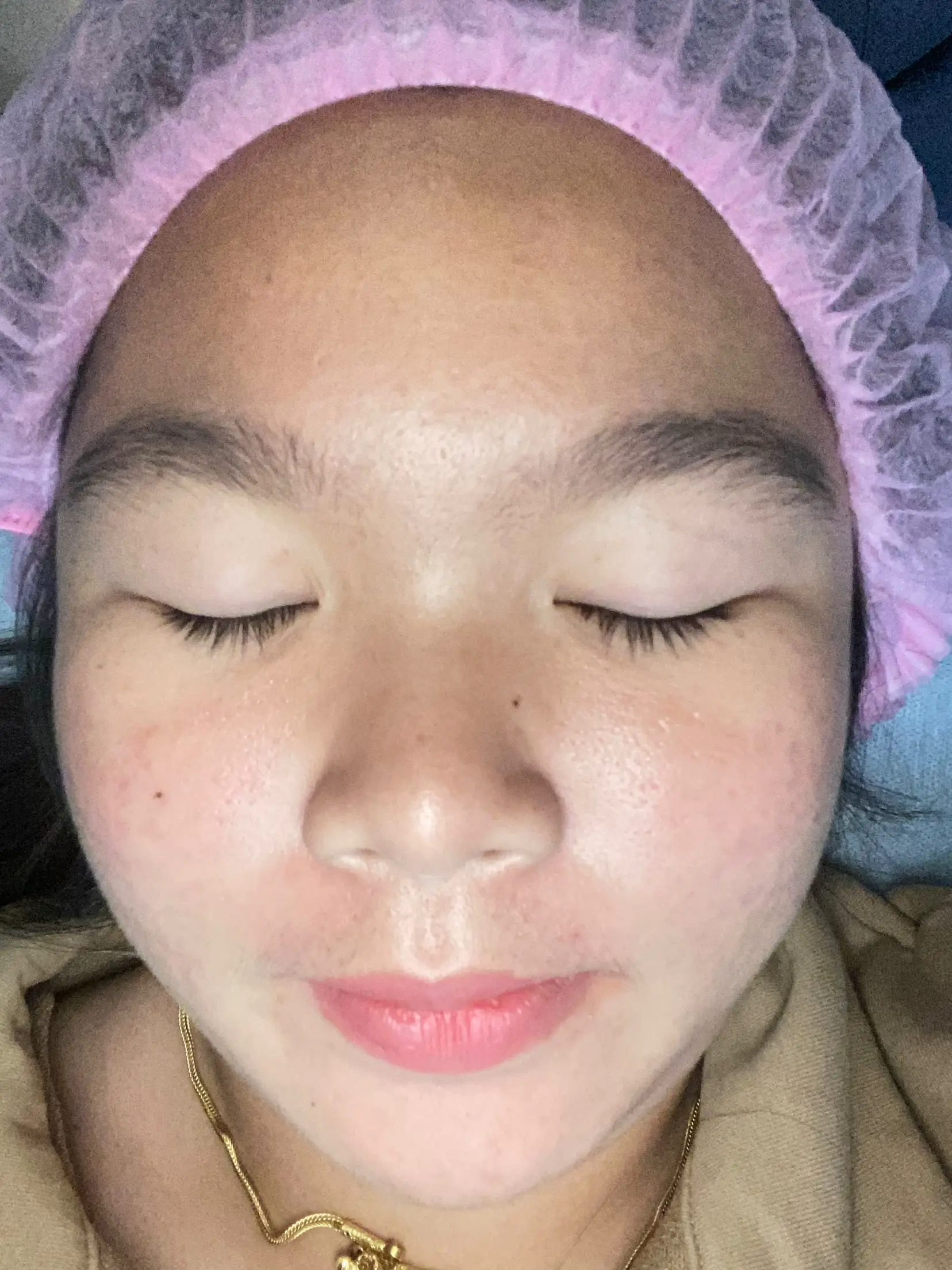 รีวิวรักษาสิวเเบบหนักสุดในชีวิต โนสปอนเซอร์‼️ | แกลเลอรีที่โพสต์โดย 𝑅𝐴𝑀𝐼𝐷𝐴. | Lemon8