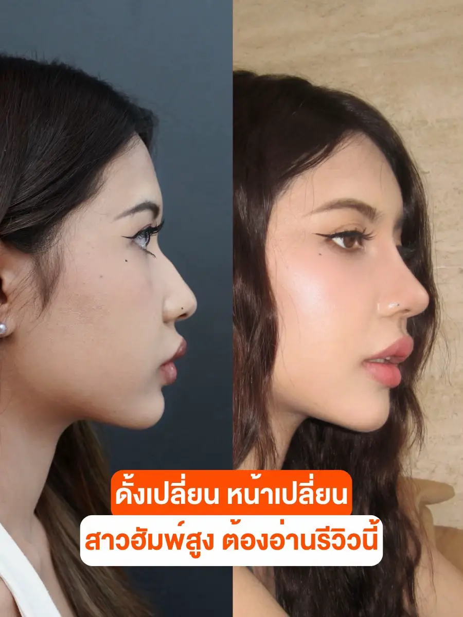 High hump girl. Want to enhance the nose, must read this review ...