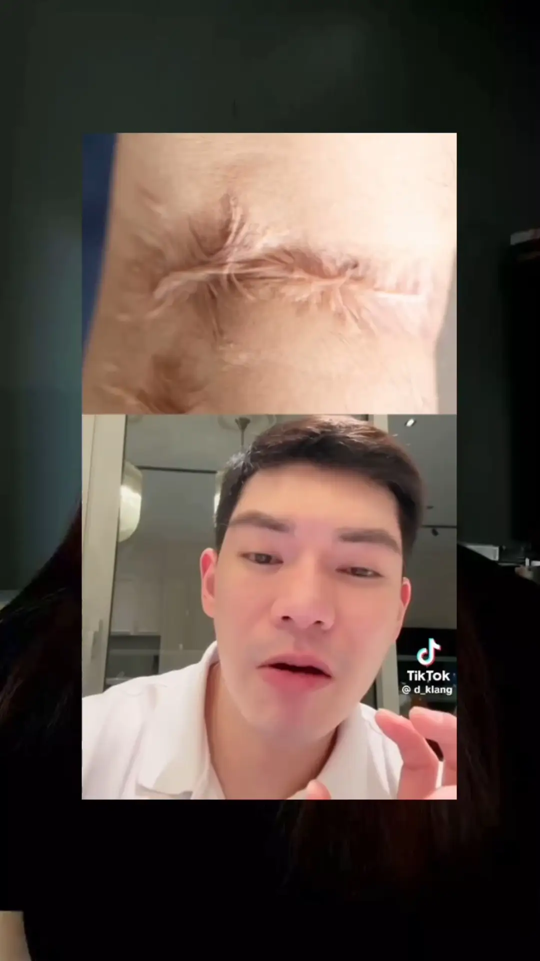 How to ดูแลแผลผ่าตัดไม่ให้เป็นคีรอยด์ !!! | วิดีโอที่เผยแพร่โดย Nutthawadee C | Lemon8