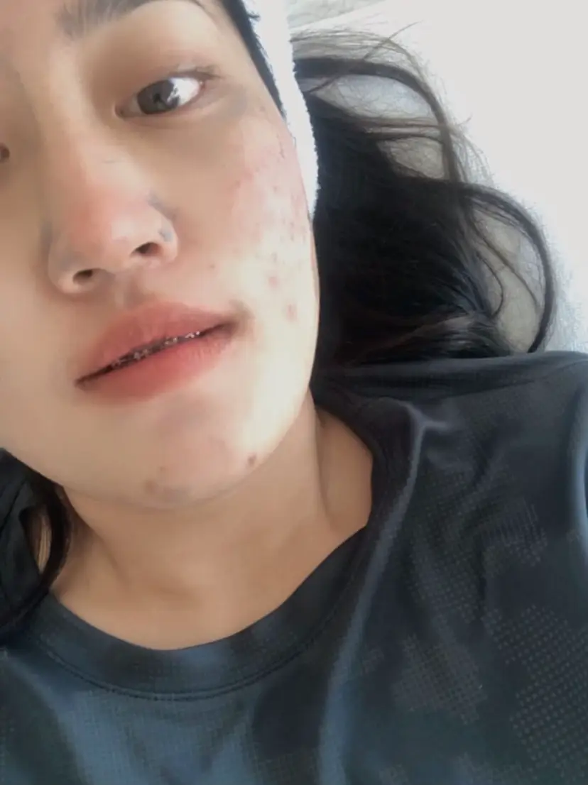 เลิกกดสิว | แกลเลอรีที่โพสต์โดย KWANJI | Lemon8