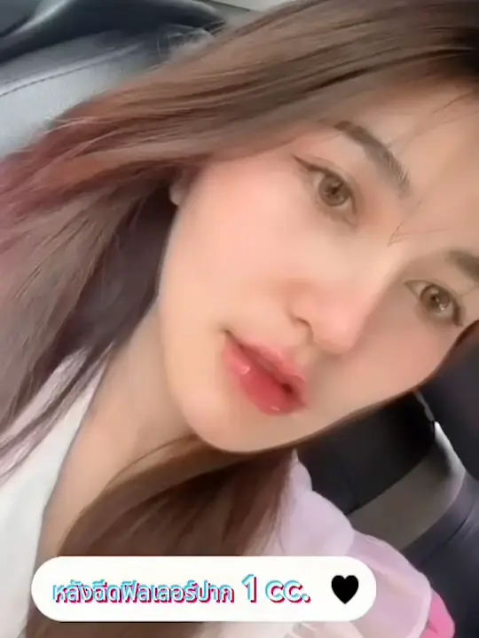 ฉีดฟิลเลอร์ที่ไหนดี? แนะนำ KTC | วิดีโอที่เผยแพร่โดย KTC CLINIC | Lemon8