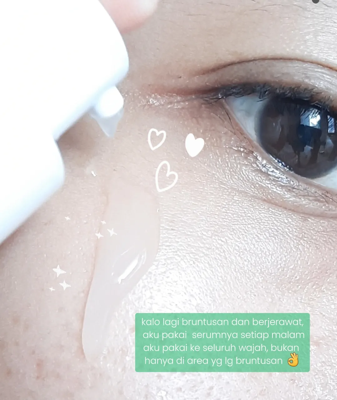 BRUNTUSAN? NO WORRY!! HERE IS THE CURE ♡ | Galeri diposting oleh shabrina𓍢ִ໋🌷͙ | Lemon8