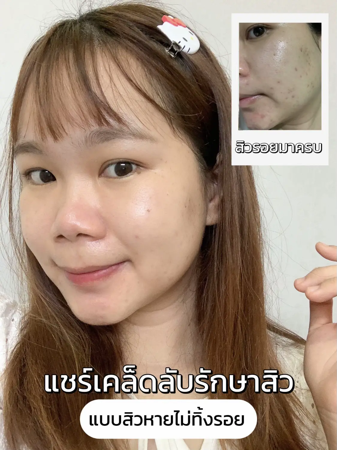 แชร์เคล็ดลับรักษาสิวแบบสิวหายไม่ทิ้งรอย | แกลเลอรีที่โพสต์โดย MOREMEWZ | Lemon8