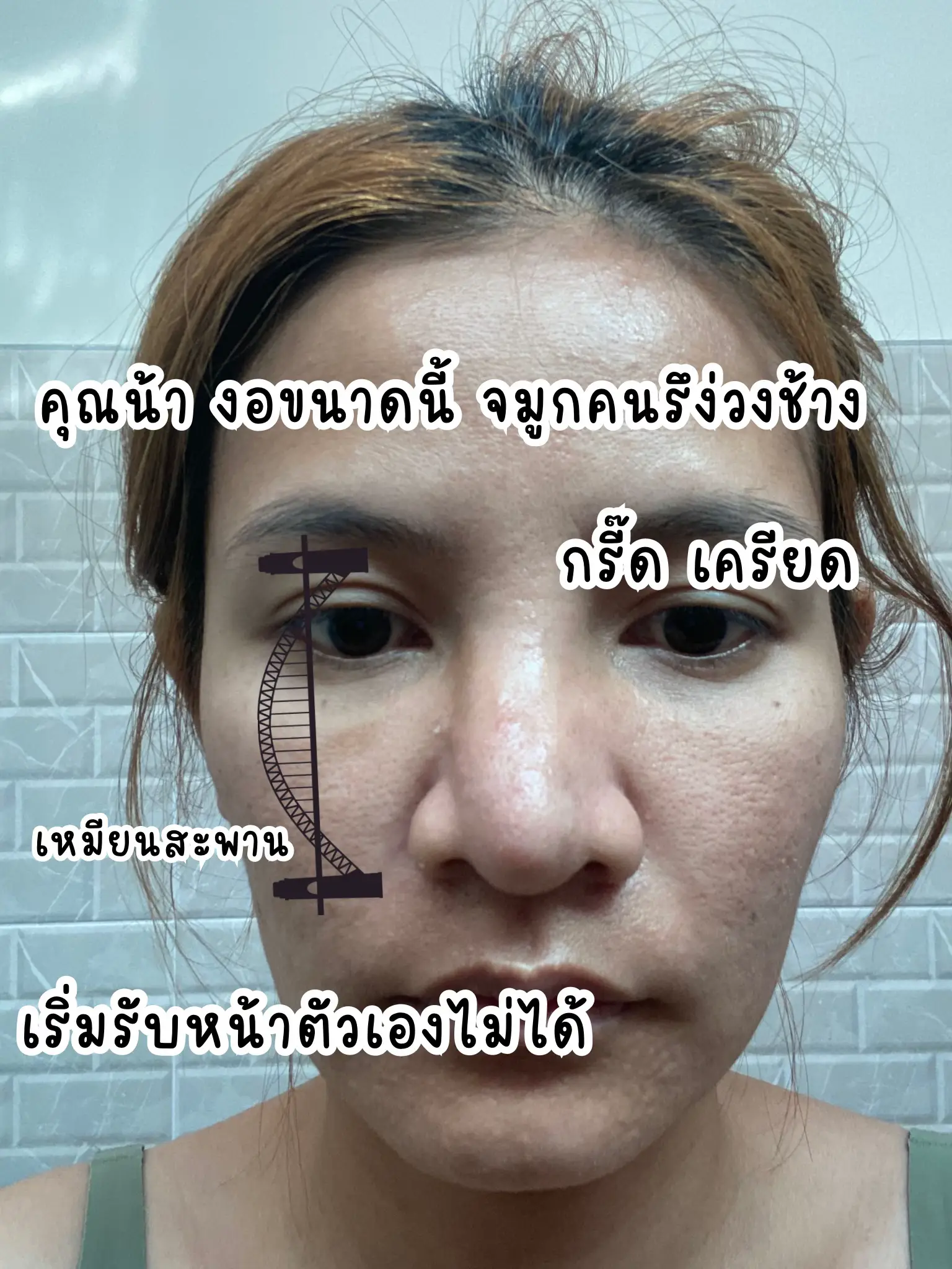 ลดบวม Proctase-P คือ ยา แก้ อะไร - การค้นหาใน Lemon8
