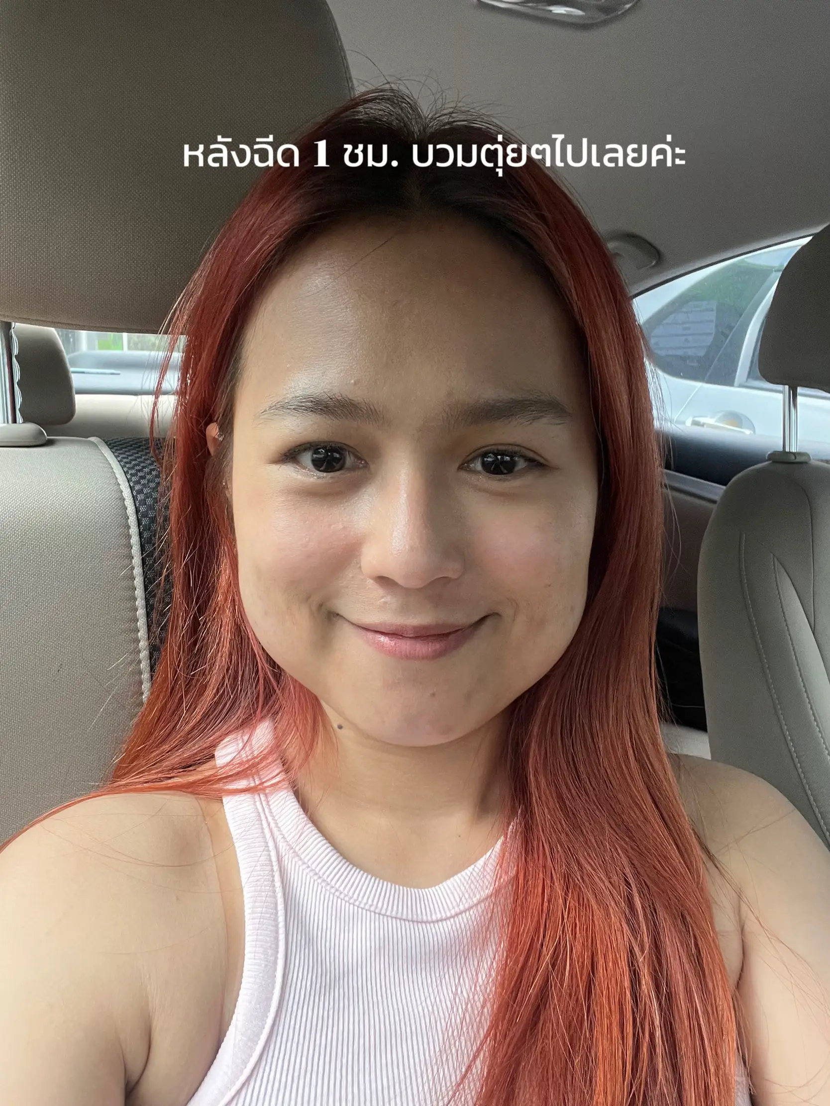 รีวิวฉีดแฟตที่ TA-MA-DA Clinic | แกลเลอรีที่โพสต์โดย Filmmiko | Lemon8