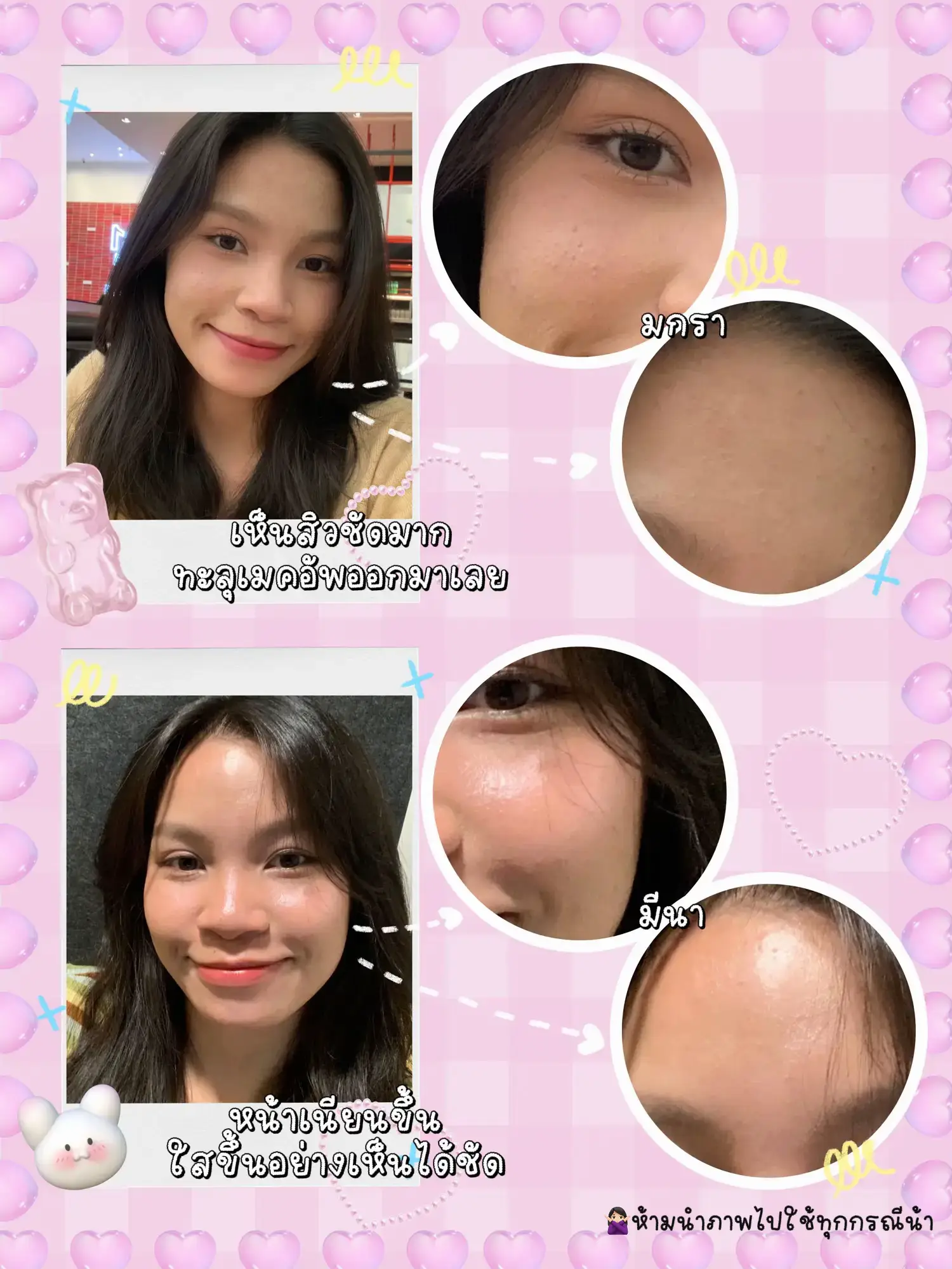 แชร์ปสก.รักษาสิว | แกลเลอรีที่โพสต์โดย Chida Beam | Lemon8