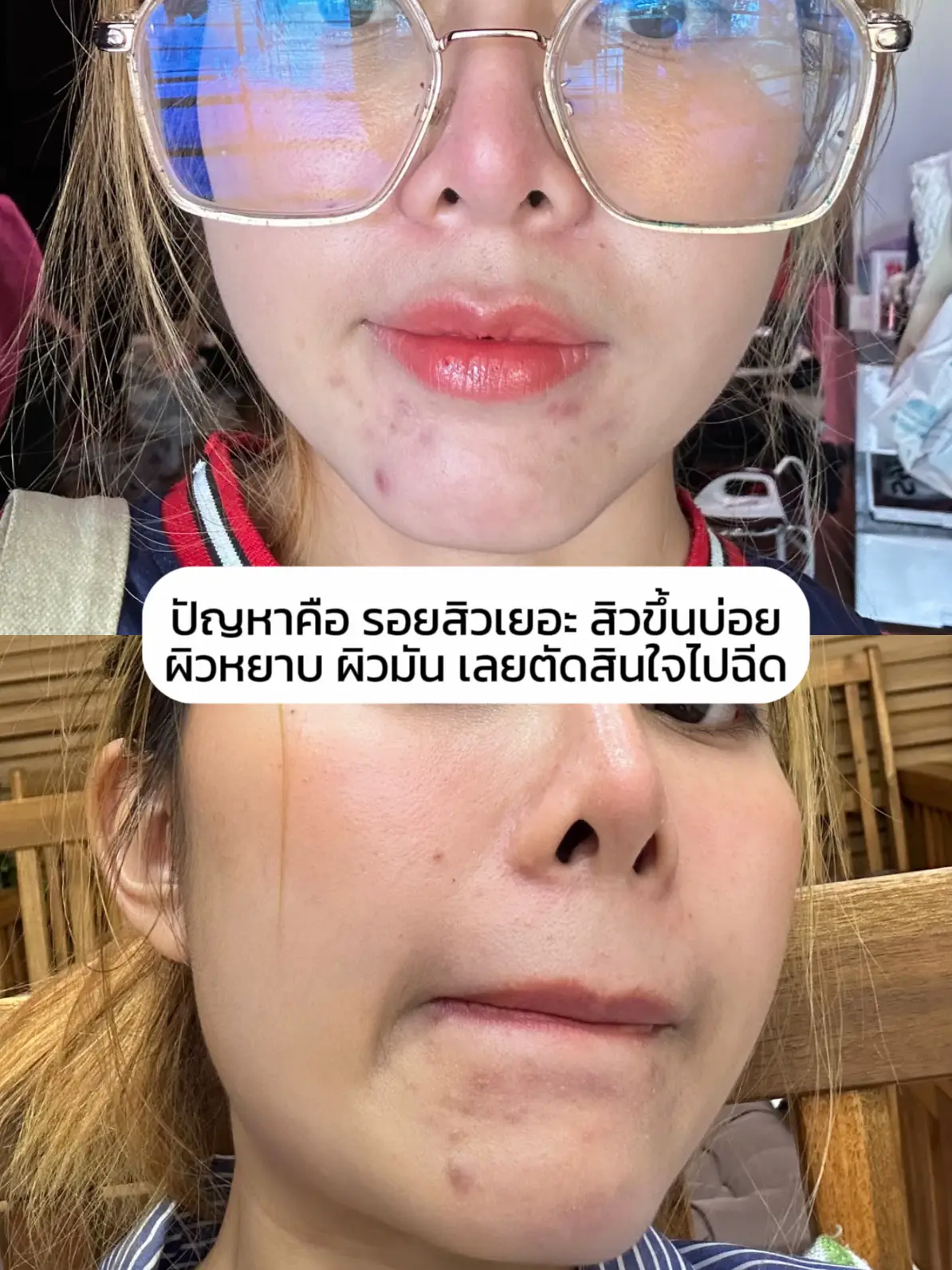 ฉีดชาแนลดียังไง ? ใครที่ต้องทำ ? ‼️🔥 | แกลเลอรีที่โพสต์โดย ssompns | Lemon8