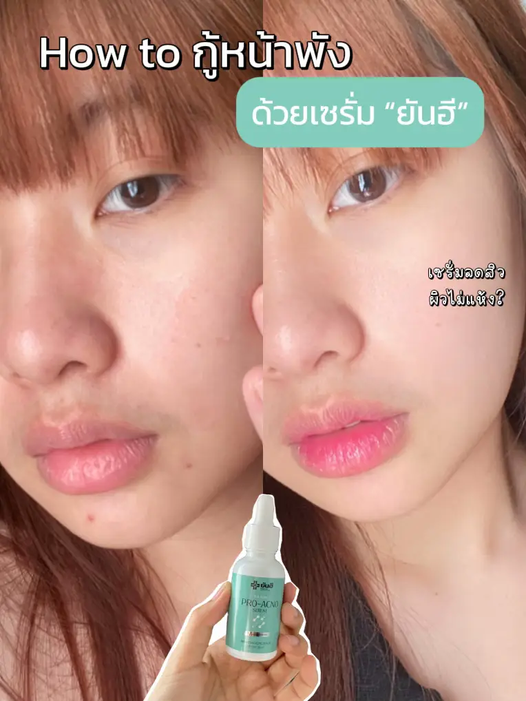 How to รักษาสิวกู้หน้าพัง ด้วยเซรั่ม “ยันฮี”🔍 | แกลเลอรีที่โพสต์โดย cherry 🍒 | Lemon8