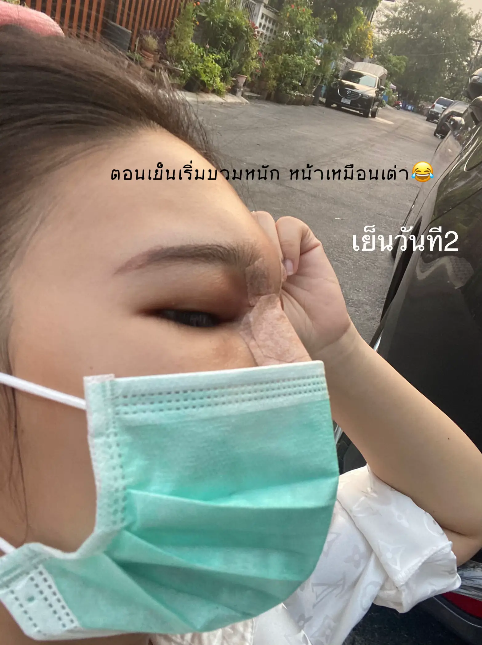 ประสบการณ์ทำจมูกครั้งแรก👃🏻 | แกลเลอรีที่โพสต์โดย Yns. | Lemon8